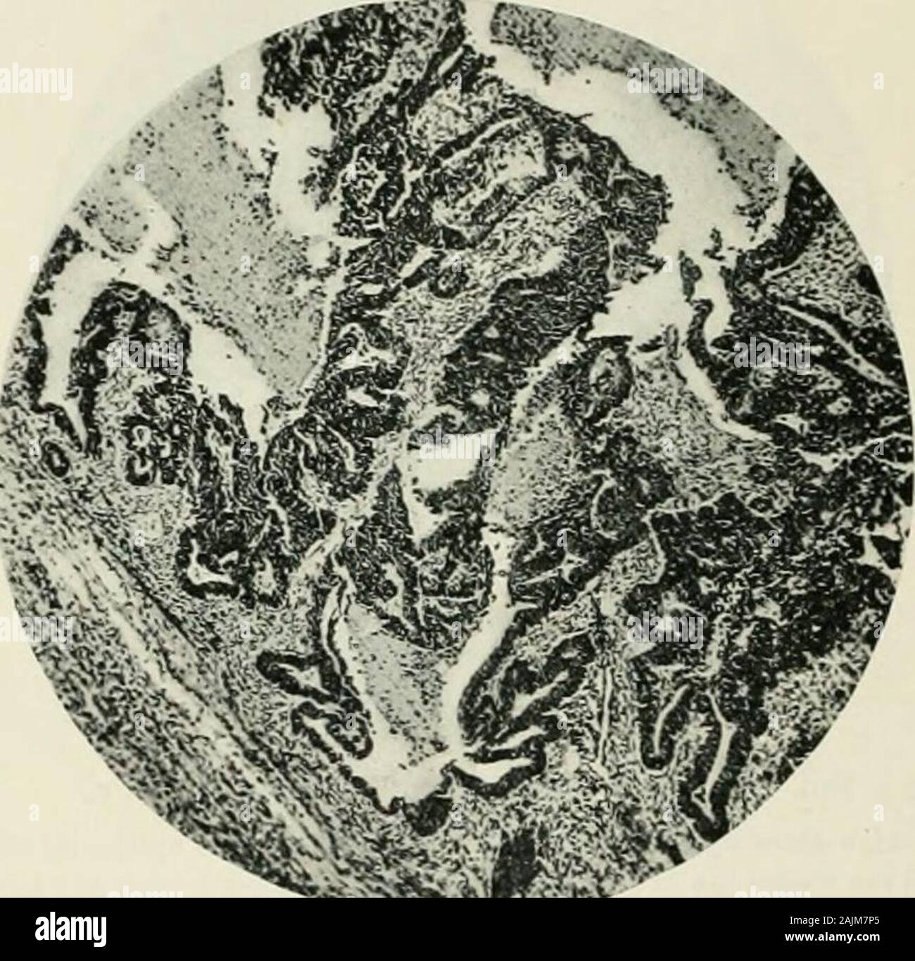 Peritoneal deposits hi-res stock photography and images - Alamy