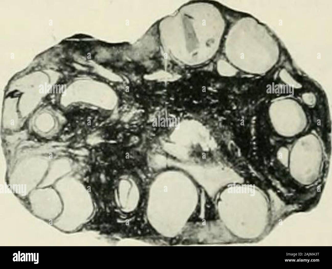 Fibrous scar hi-res stock photography and images - Alamy