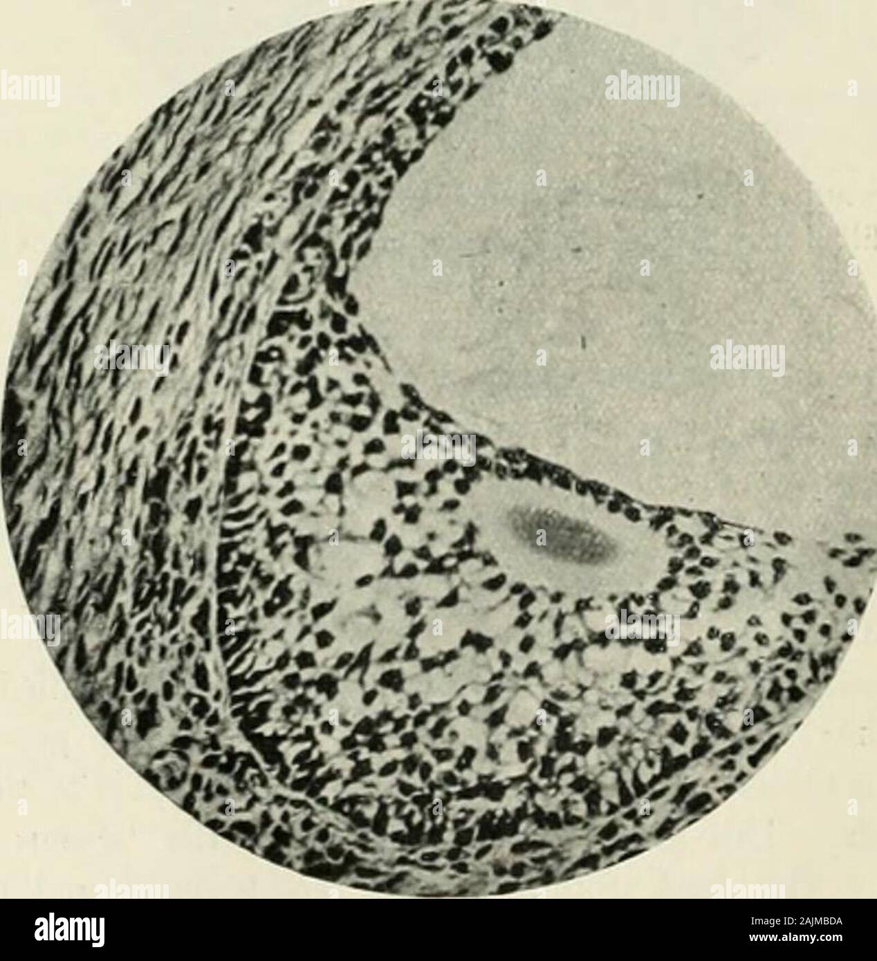 Gynecological diagnosis and pathology . Fig. 152.—Ovaky : Ripe Follicle ...