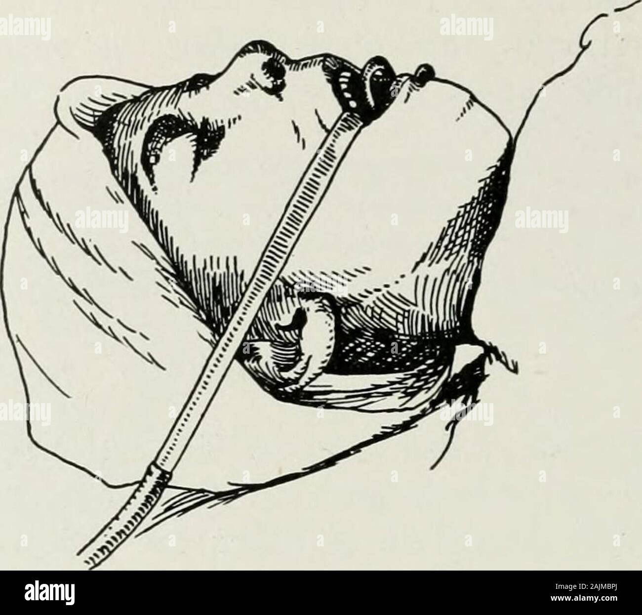 Chloroform anesthesia hi-res stock photography and images - Alamy