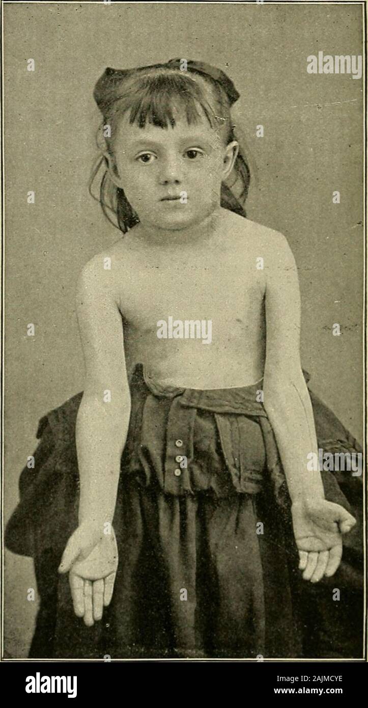 A system of medicine, by many writers; . Fig. 15.—Paralysis and atrophy ...