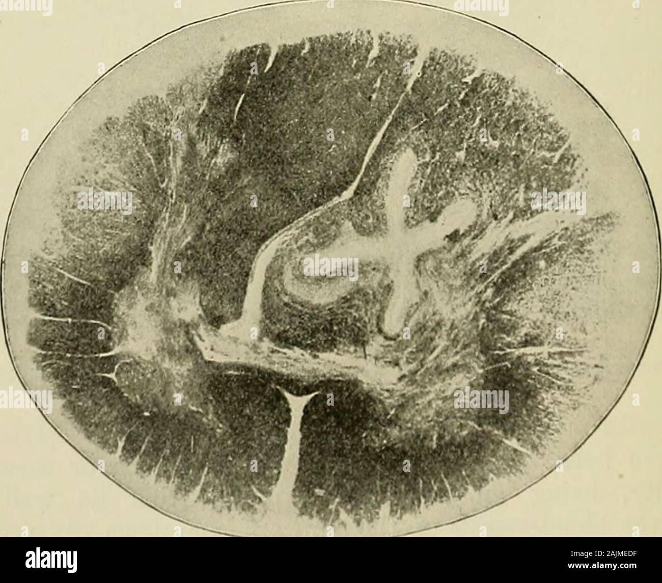Syringomyelia Cross Section