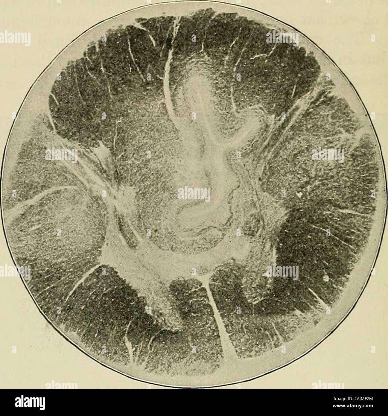Syringomyelia Cross Section