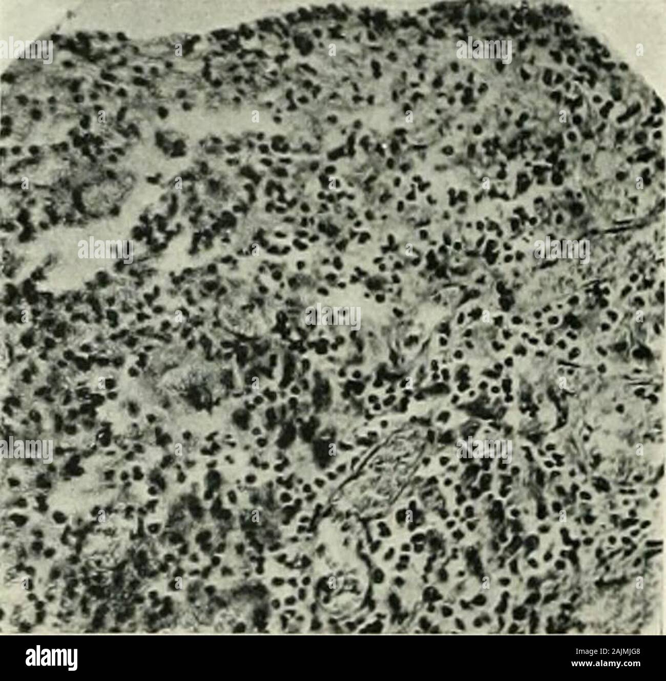Gynecological diagnosis and pathology . Fig. 132.—Salpingitis ...