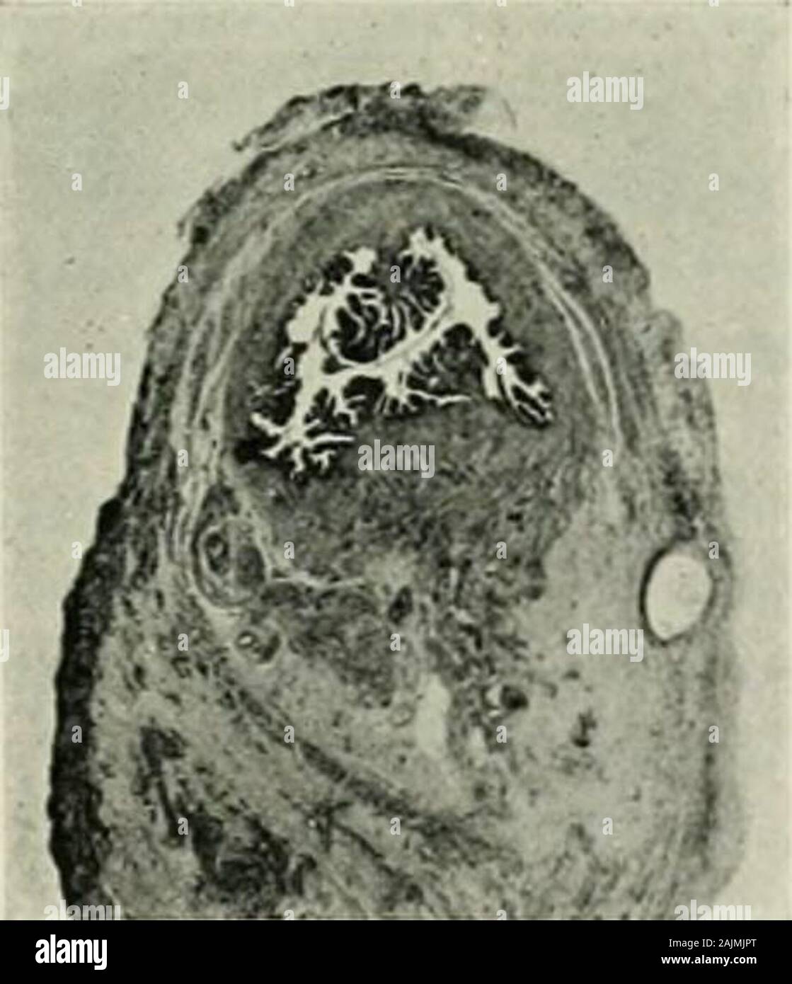 Gynecological diagnosis and pathology . Fig. 131.—Salpingitis. One of ...