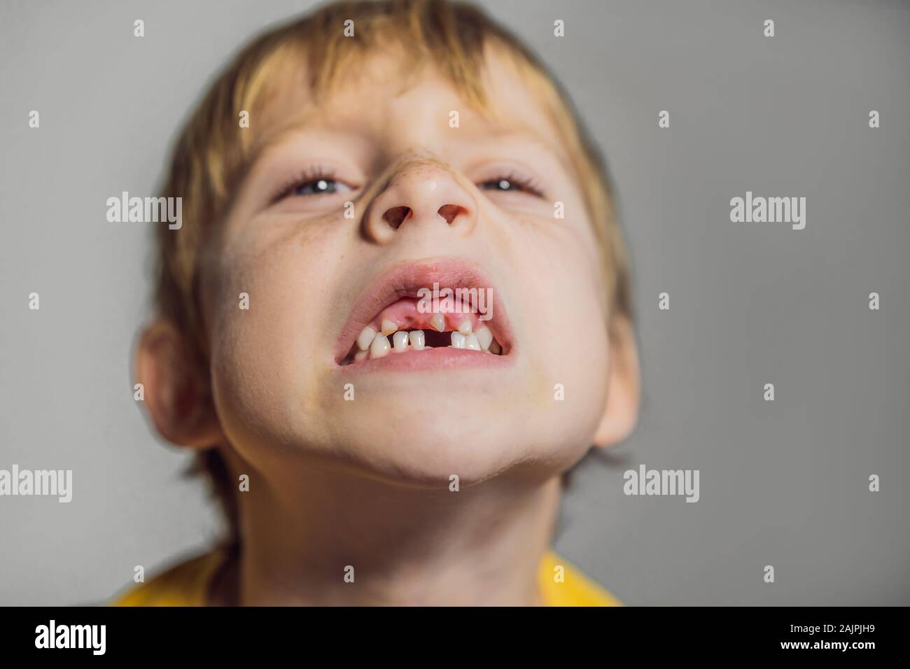 Abnormal boy tooth. The extra narrow strange tooth grew in the boy's ...