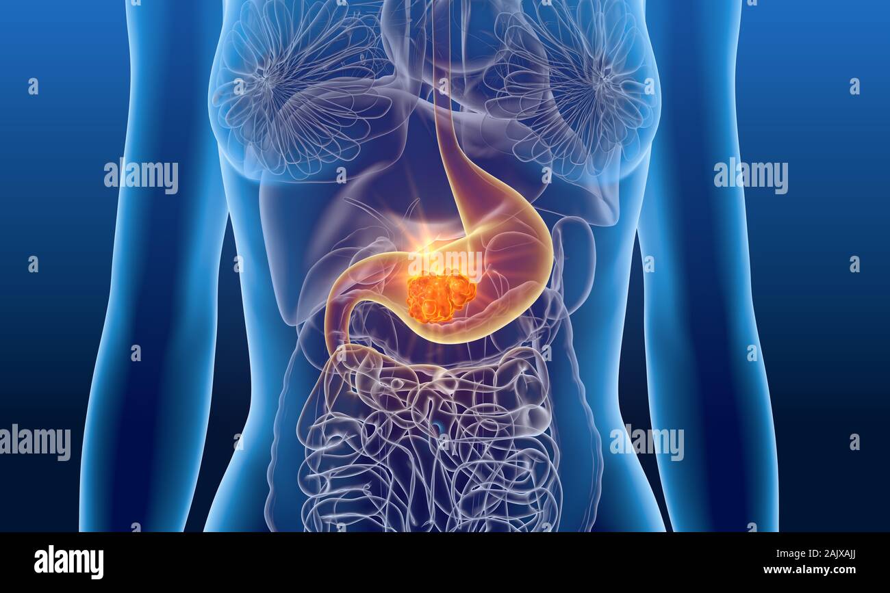 Stomach cancer hi-res stock photography and images - Alamy