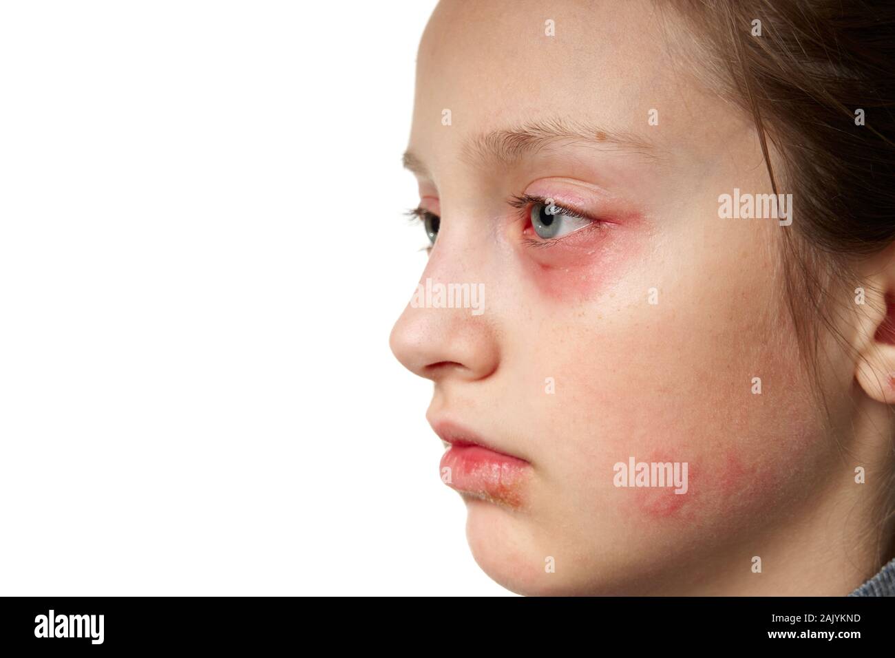 Allergic reaction, skin rash, close view portrait of a girl's face ...