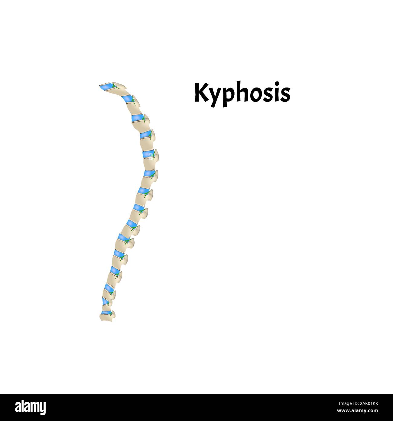 The position of the spine with kyphosis. Spinal curvature, kyphosis ...