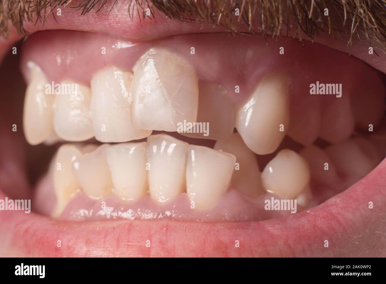 Close-up of very crooked teeth in an adult bearded guy. Not the right ...