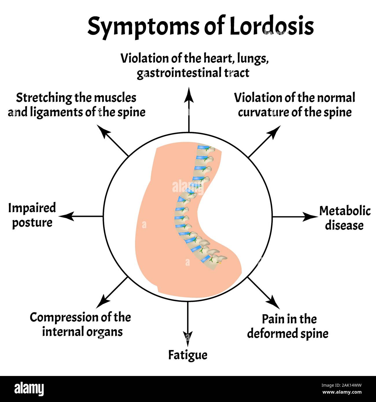 Symptoms of lordosis. Spinal curvature, kyphosis, lordosis, scoliosis ...