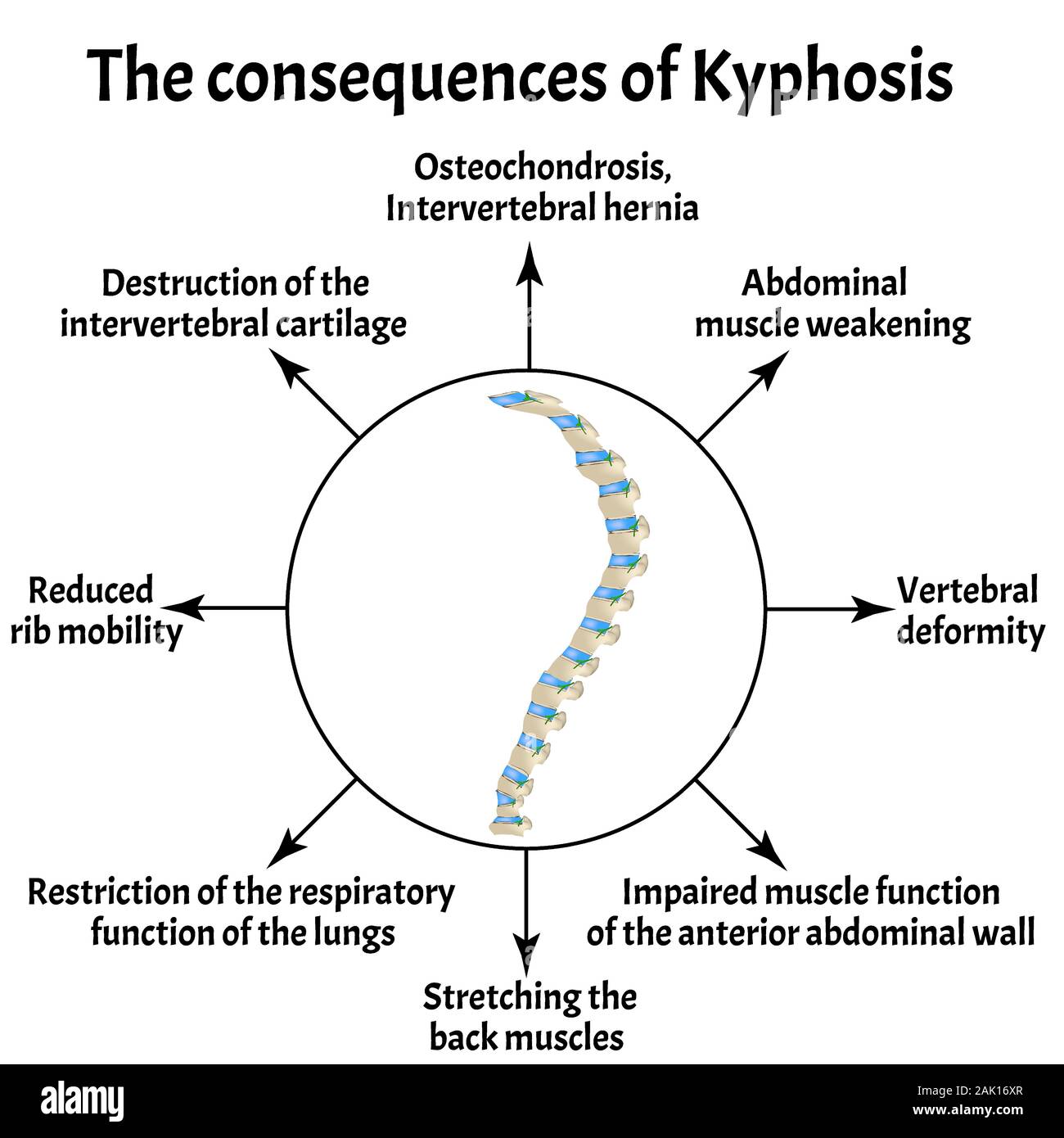 The consequences of kyphosis. Spinal curvature, kyphosis, lordosis ...