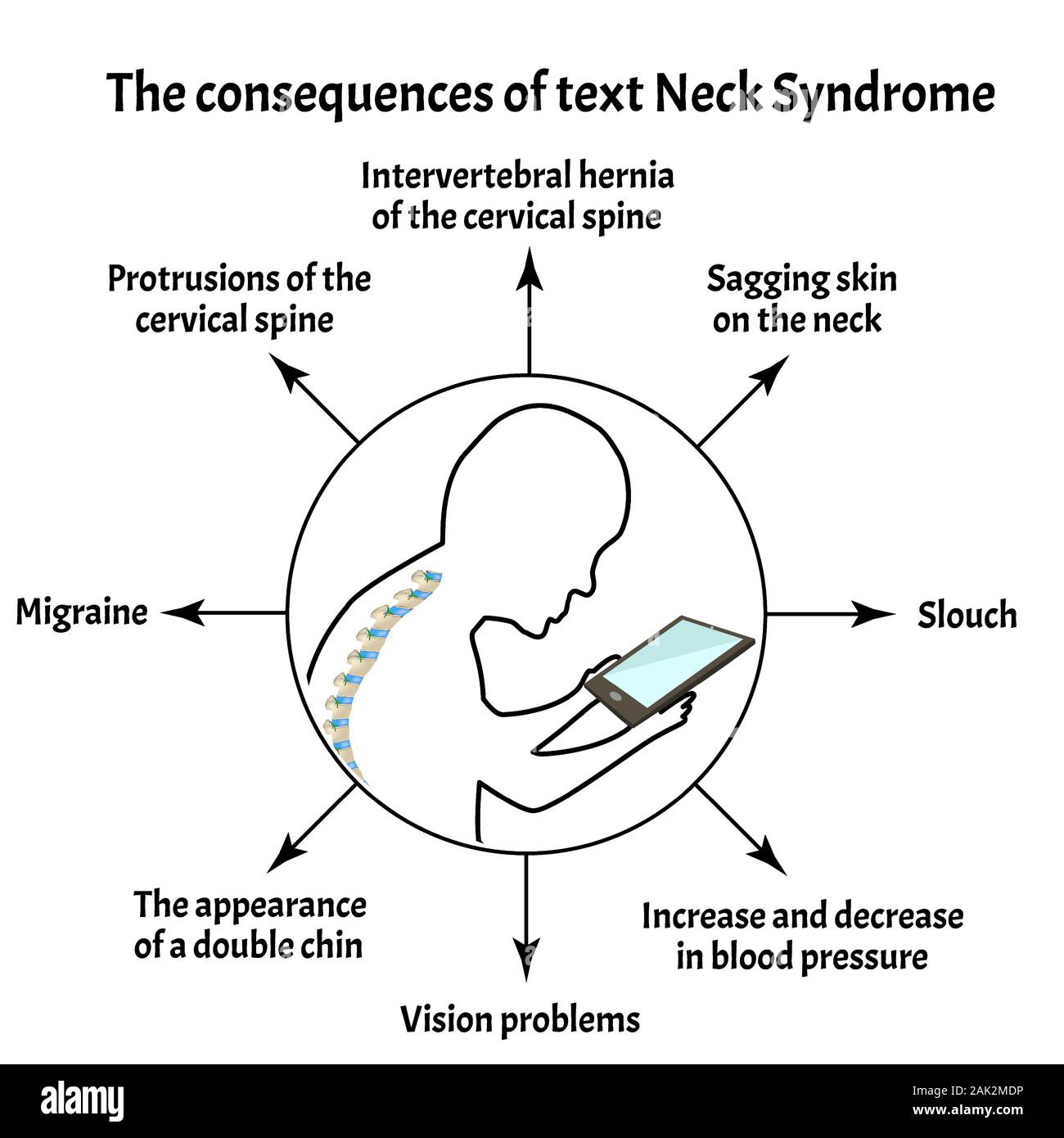 Consequences of Text Neck Syndrome. Spinal curvature, kyphosis ...