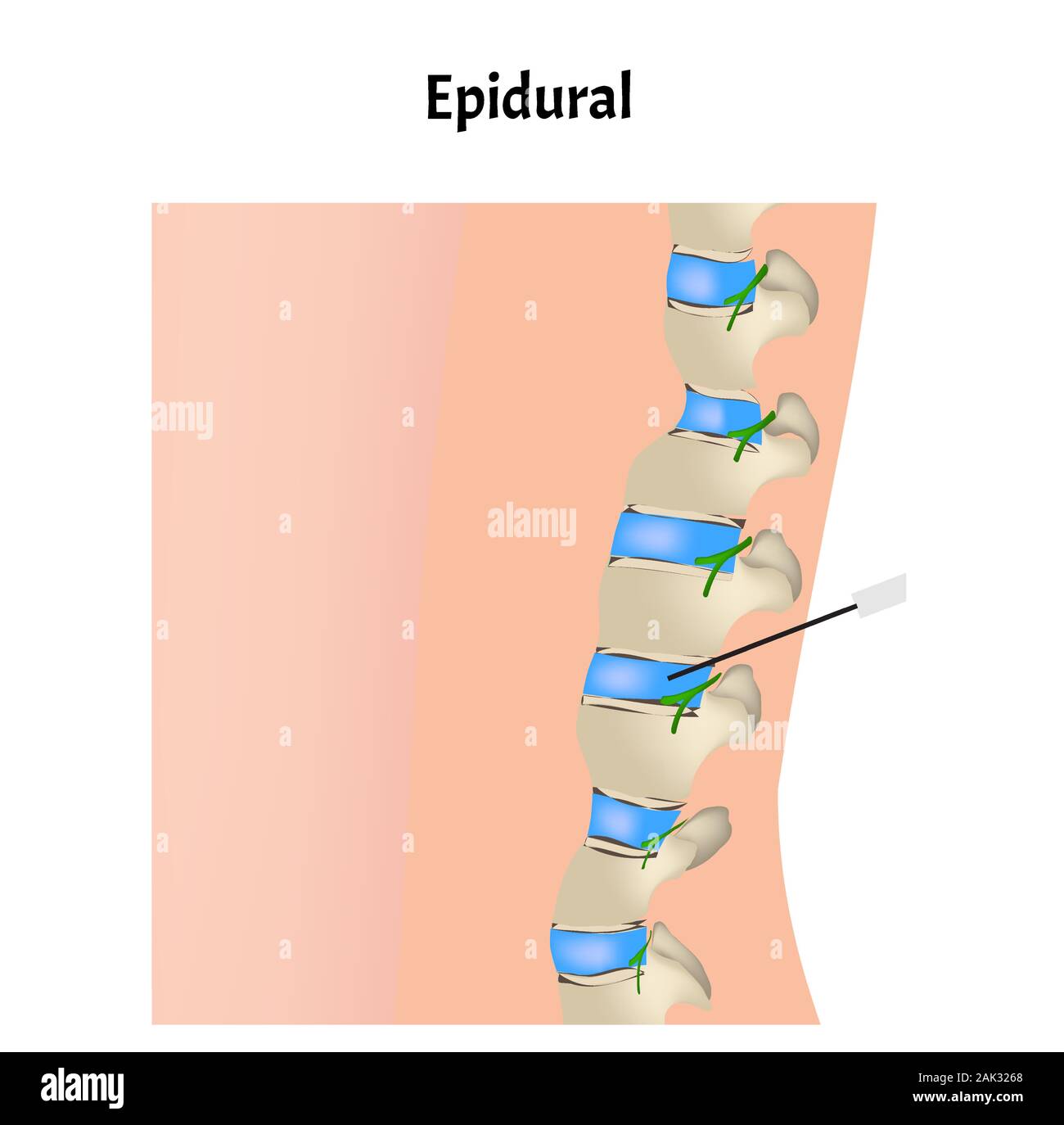 Epidural anesthesia during childbirth. Epidural anesthesia of pregnant ...