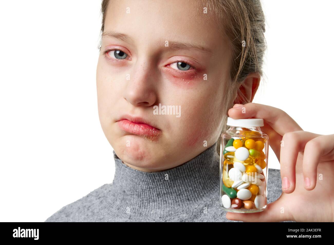 Allergic reaction, skin rash, close view portrait of a girl's face ...