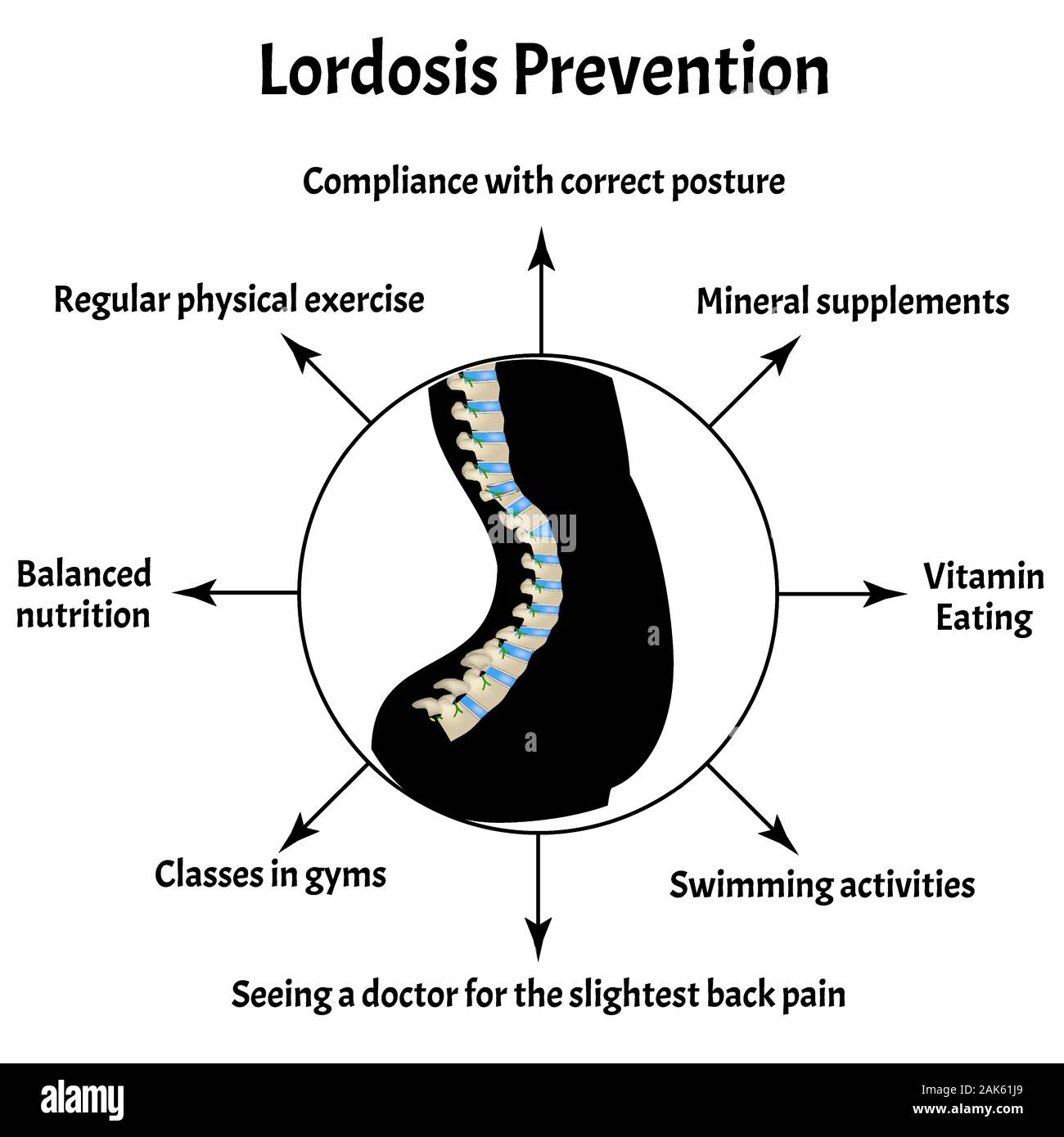 Prevention of lordosis. Spinal curvature, kyphosis, lordosis, scoliosis ...