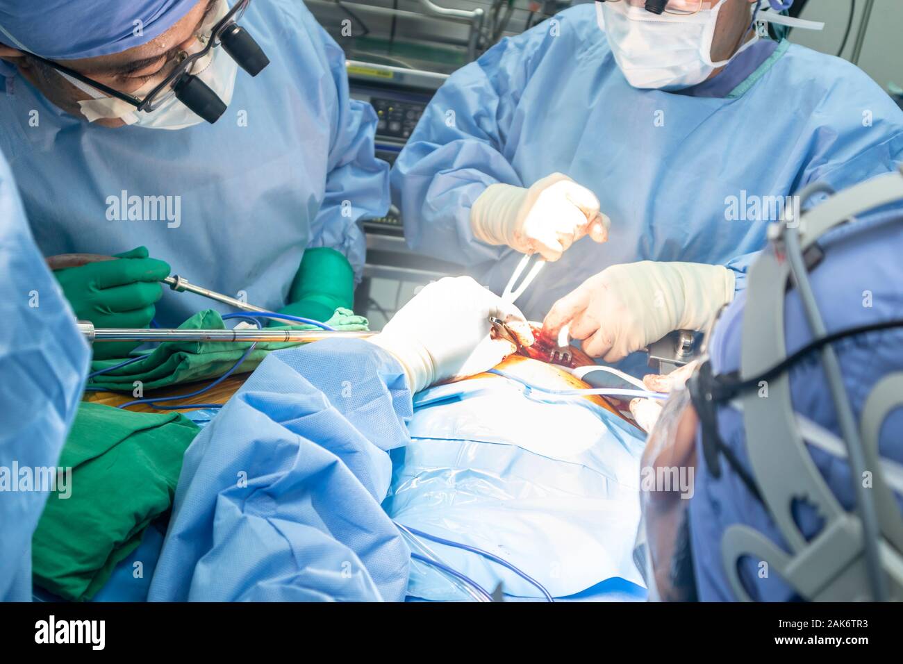 Close up group of surgeons in Surgery operating room. Medical team of ...