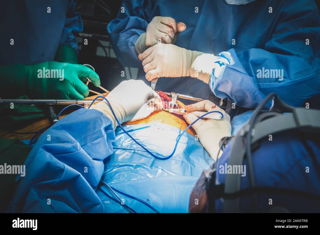 Close up group of surgeons in Surgery operating room. Medical team of ...