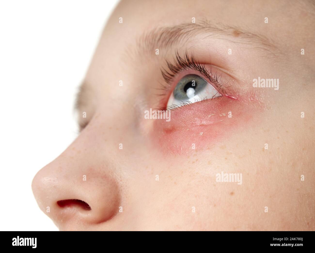 Allergic reaction, skin rash, close view portrait of a girl's face ...