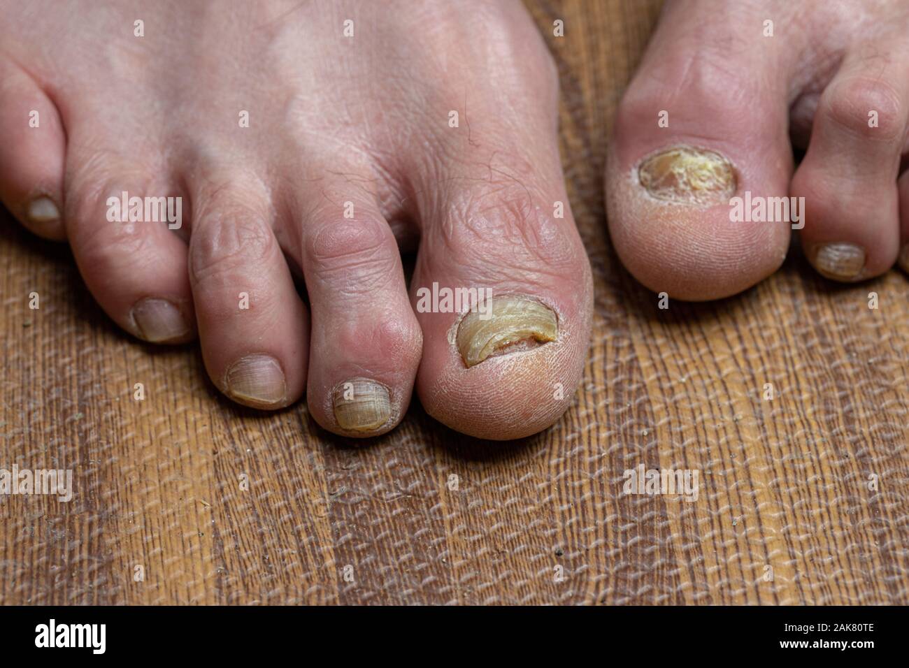 Curled Toes High Resolution Stock Photography and Images - Alamy