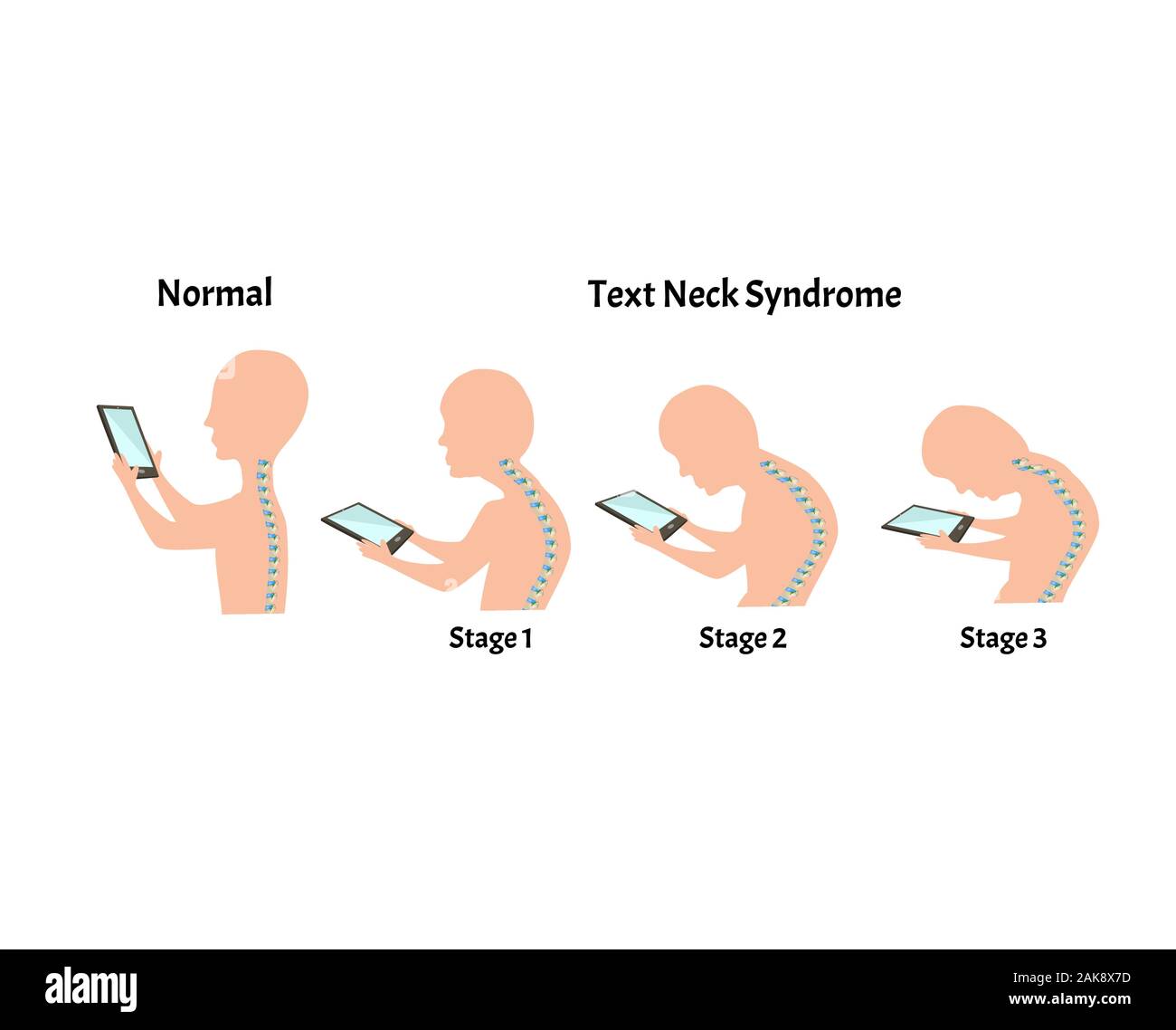 Improper posture symptoms. Stage Text Neck Syndrome. Spinal curvature ...