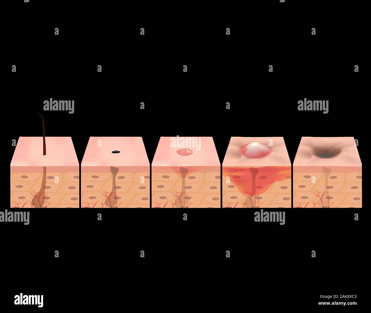 Treatment of open comedones, inflamed acne, acne cysts. Sore acne ...