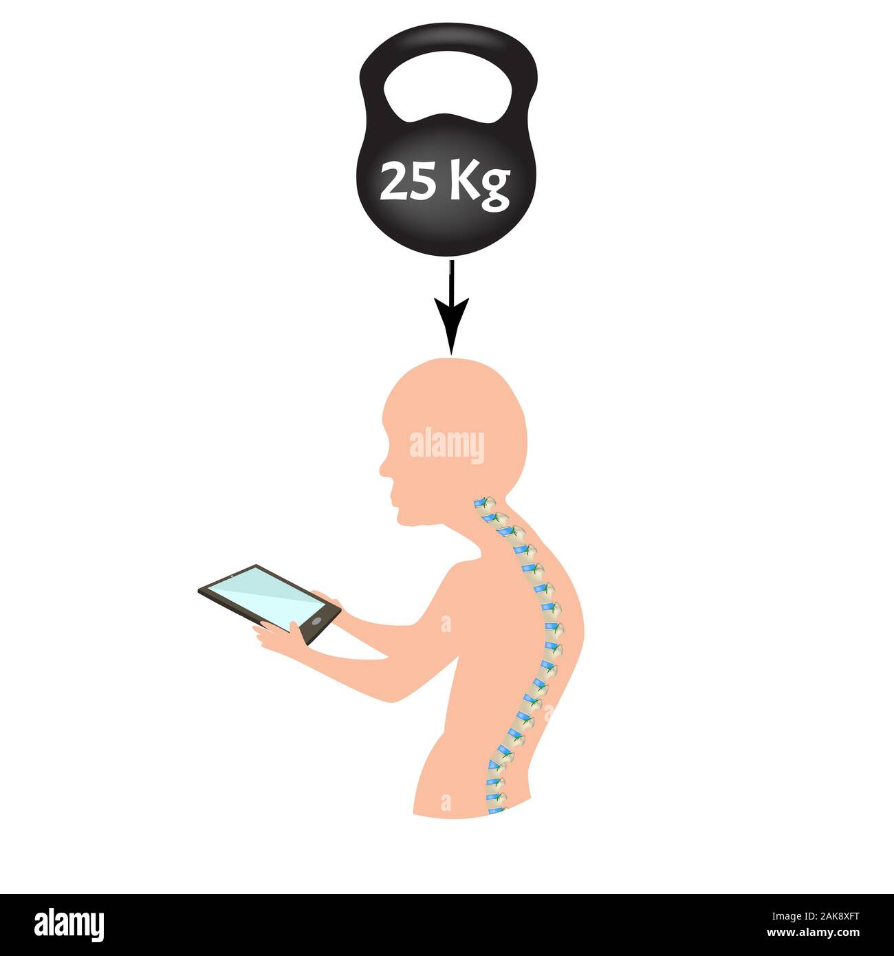 Improper posture symptoms. Text Neck Syndrome. Spinal curvature ...