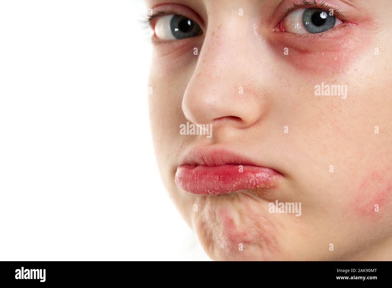 Allergic reaction, skin rash, close view portrait of a girl's face ...
