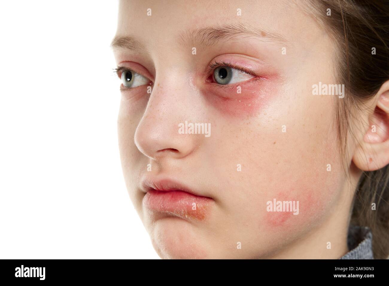 Allergic reaction, skin rash, close view portrait of a girl's face ...