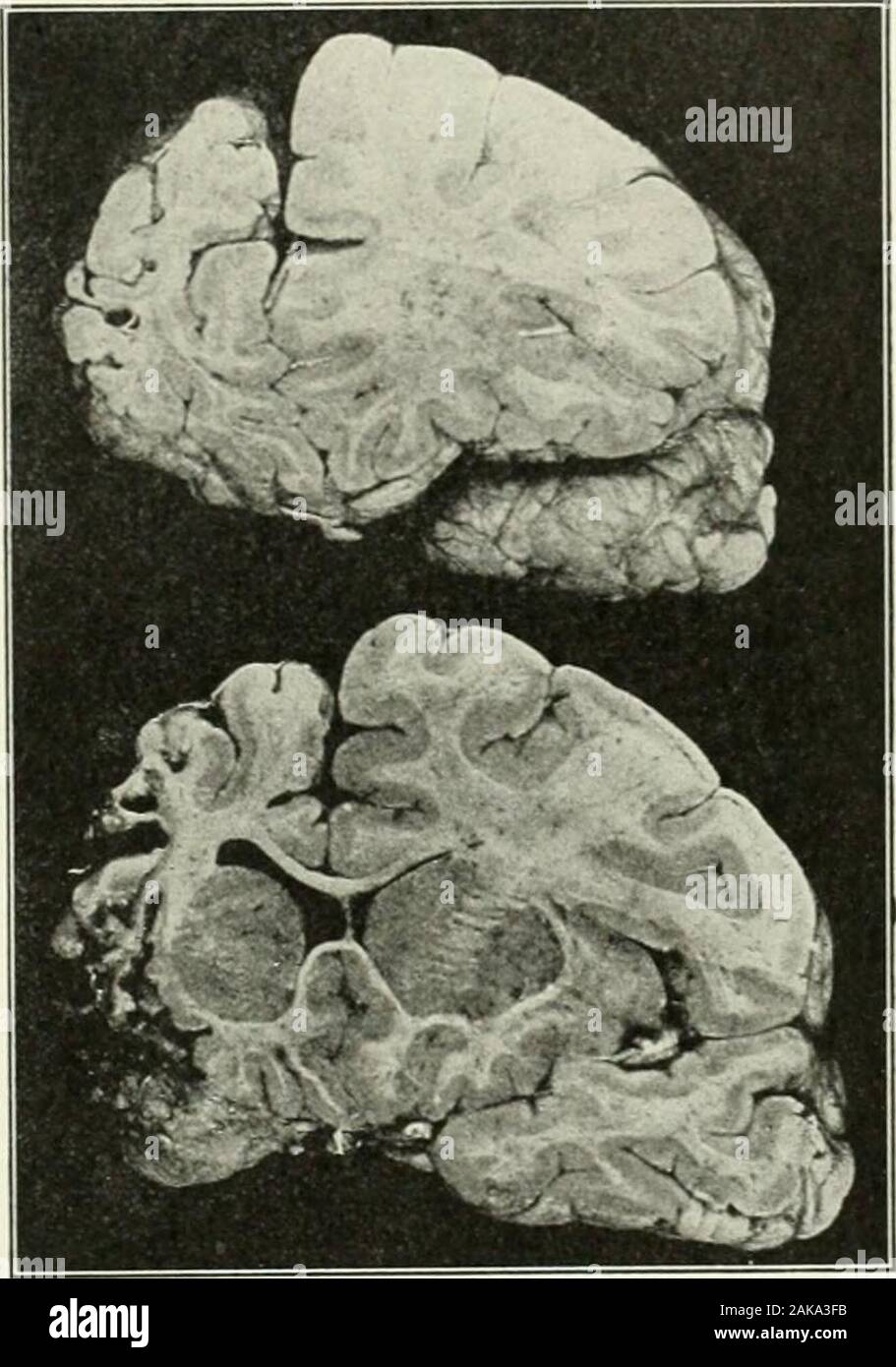 Microcephalic hi-res stock photography and images - Alamy
