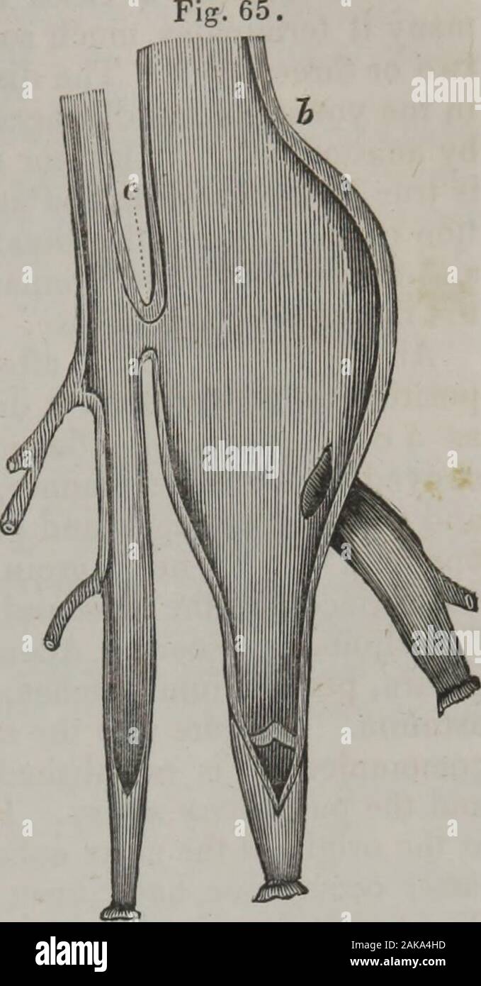 Venesection hi-res stock photography and images - Alamy