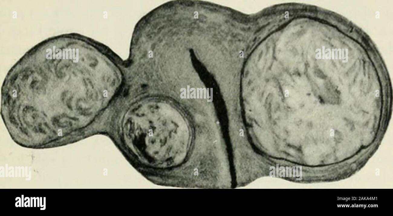 Gynecological diagnosis and pathology . Fio. 104.—Uterus with Sub ...