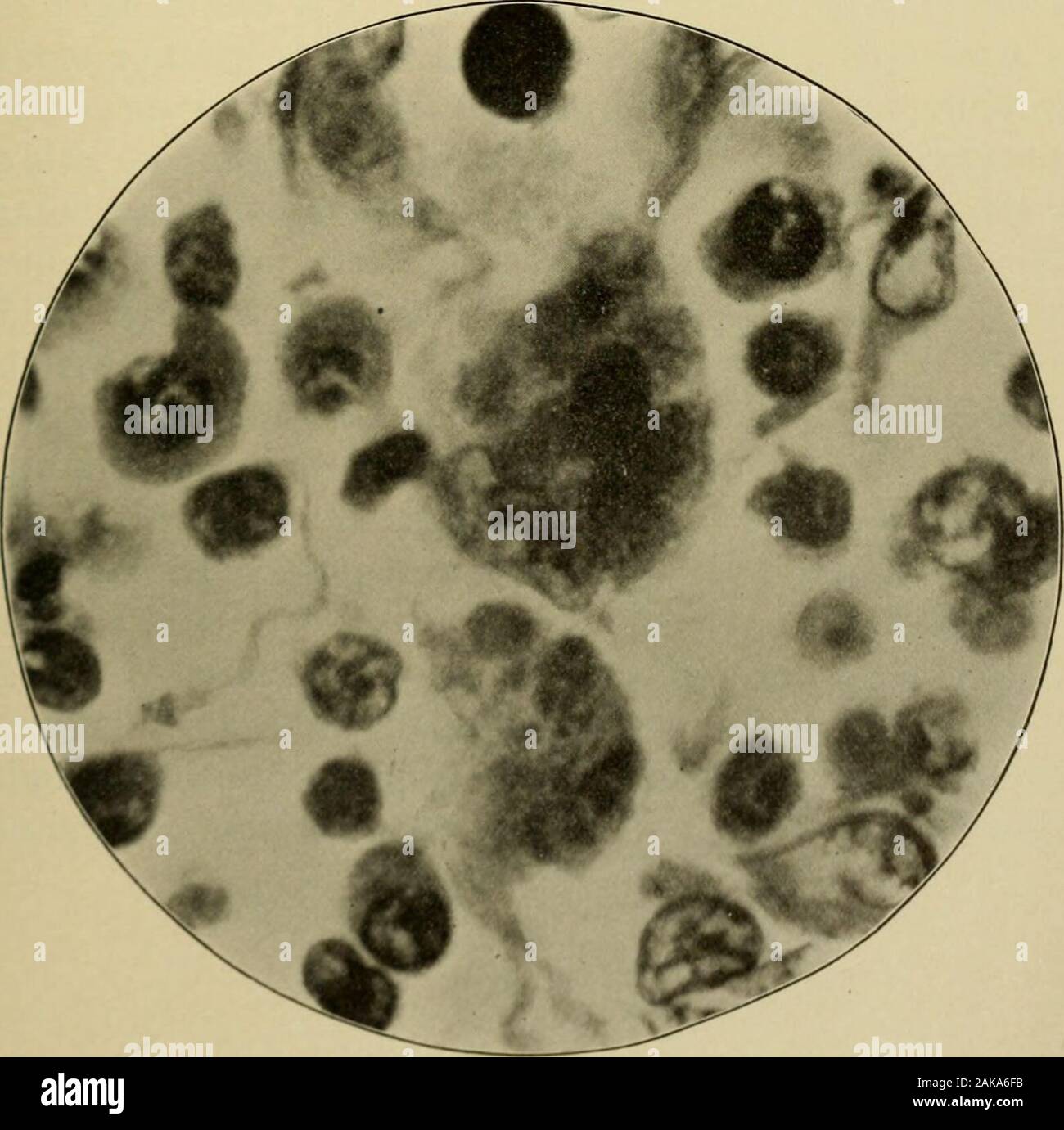 Swollen blood cells hi-res stock photography and images - Alamy