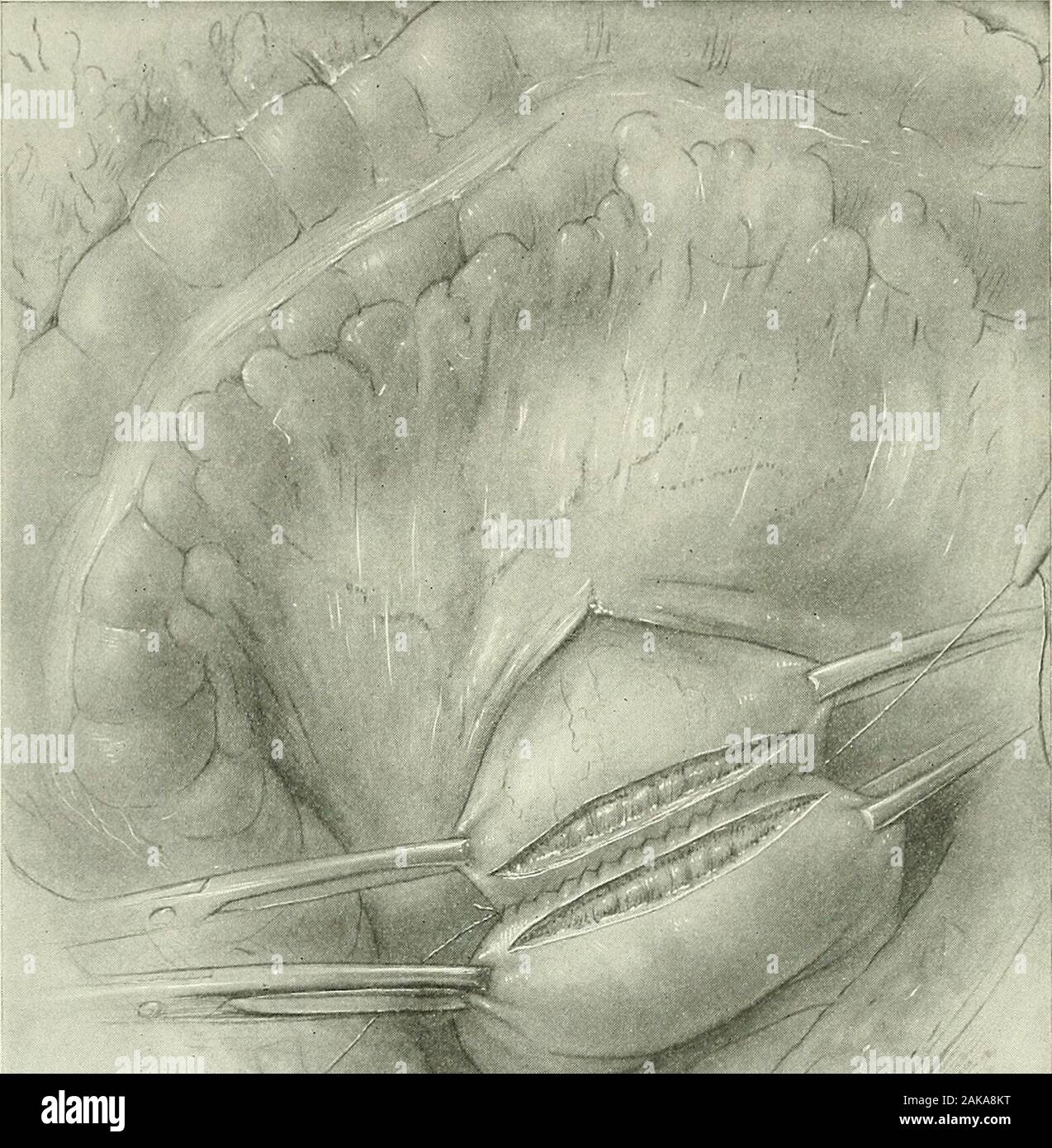 Transverse mesocolon hi-res stock photography and images - Alamy