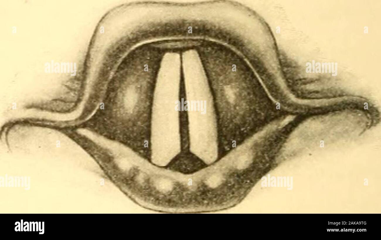 Diseases of the nose and throat . Fig. 136. Bilateral Paralysis ...