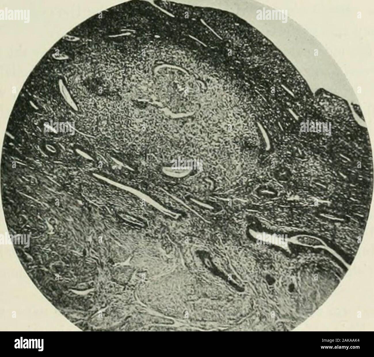 Gynecological diagnosis and pathology . Fin. 91. -Tissue removed by ...