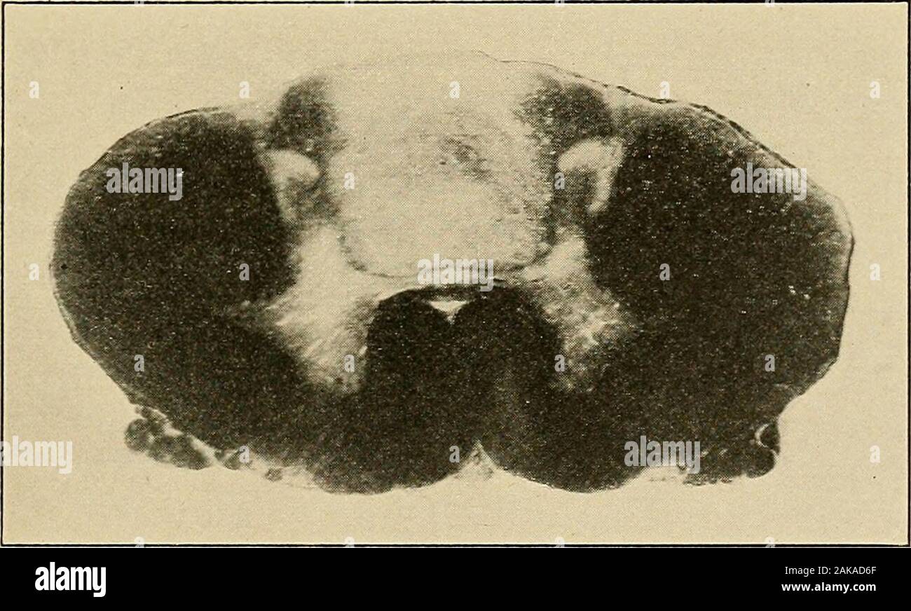 Leptomeningitis hi-res stock photography and images - Alamy