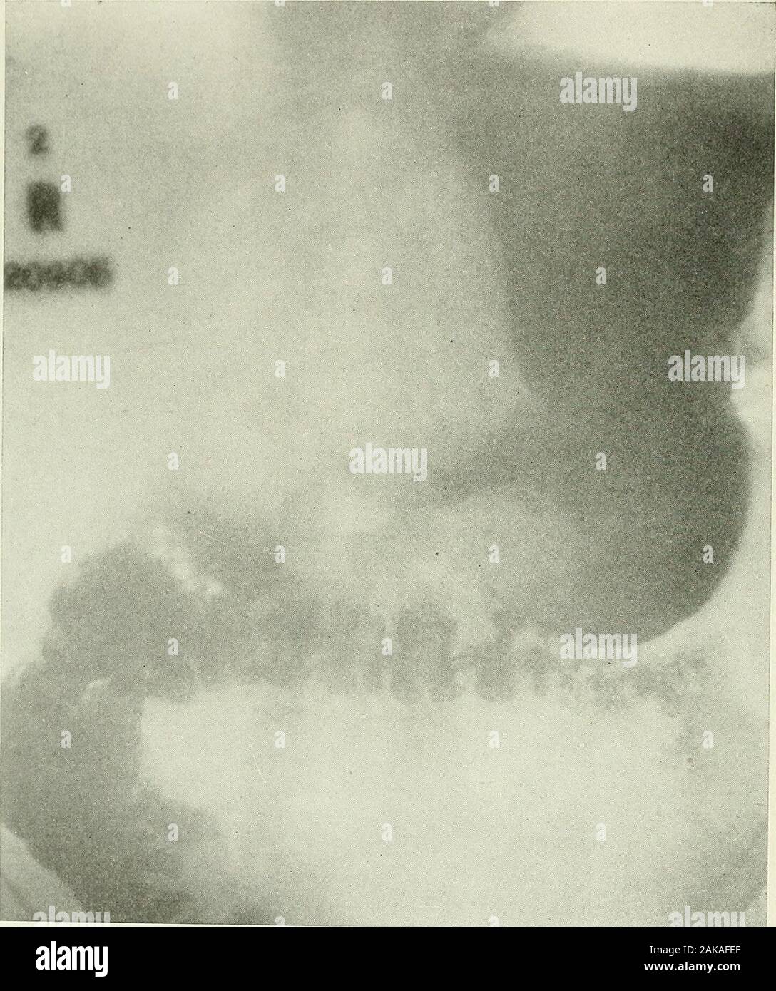 Pyloric antrum hi-res stock photography and images - Alamy