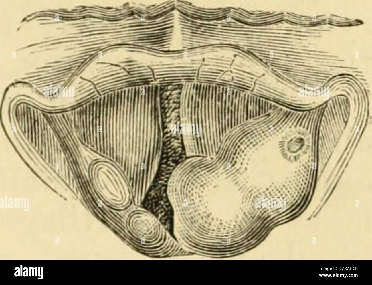 Neck abscess hi-res stock photography and images - Alamy