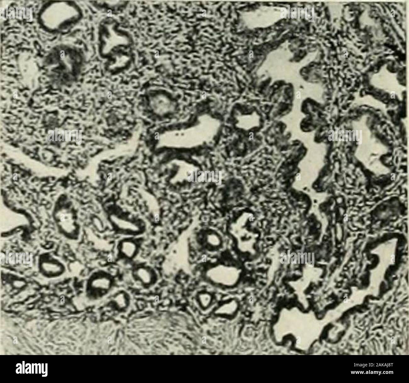 Gynecological diagnosis and pathology . Fig. -Mucous Membrane of Uterus ...