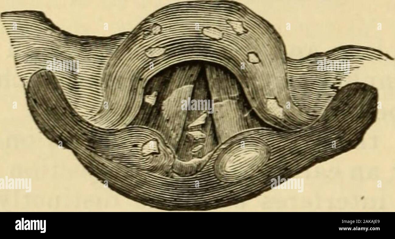 Throat ulcers hi-res stock photography and images - Alamy