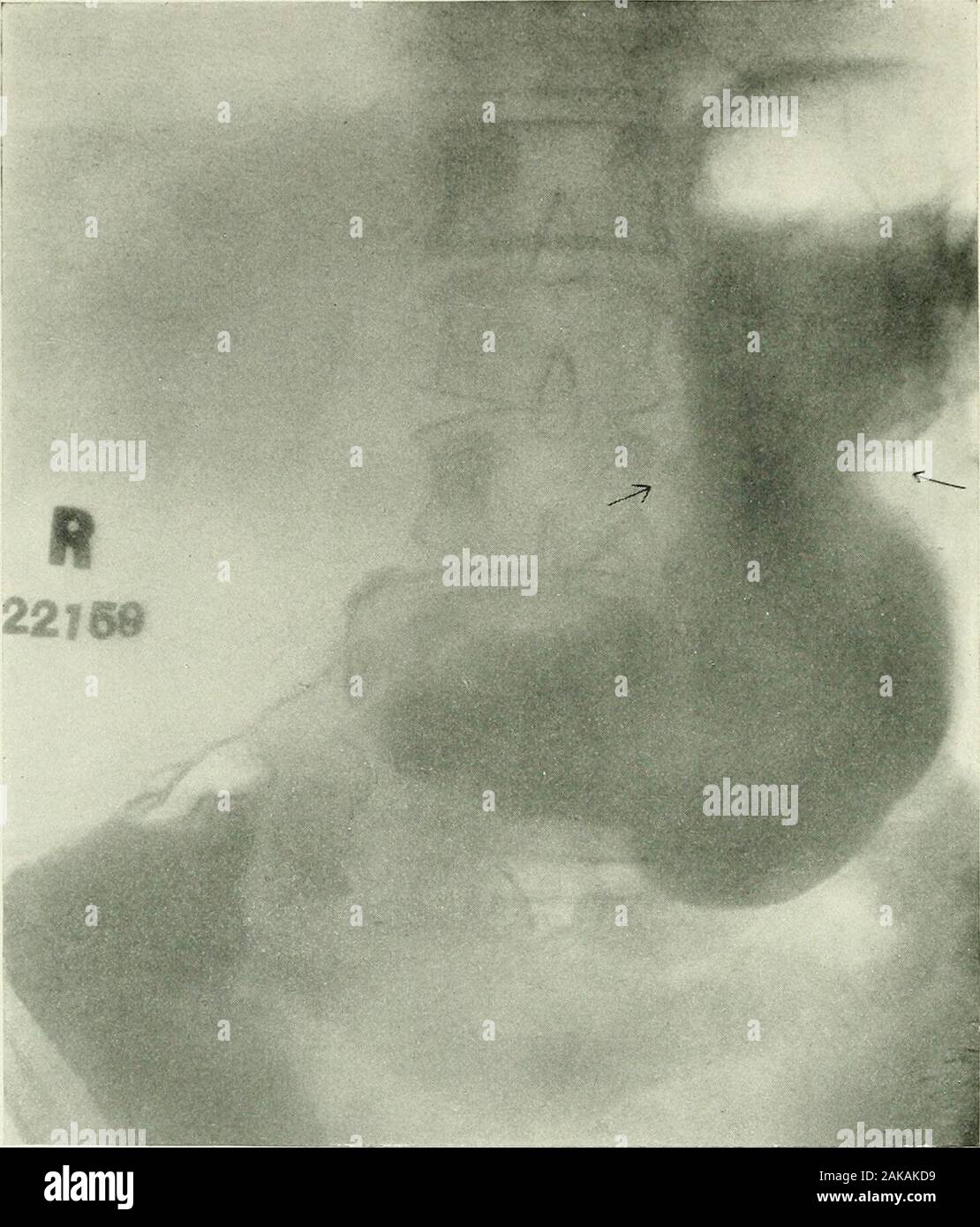 Cancer of the stomach; a clinical study of 921 operatively and ...