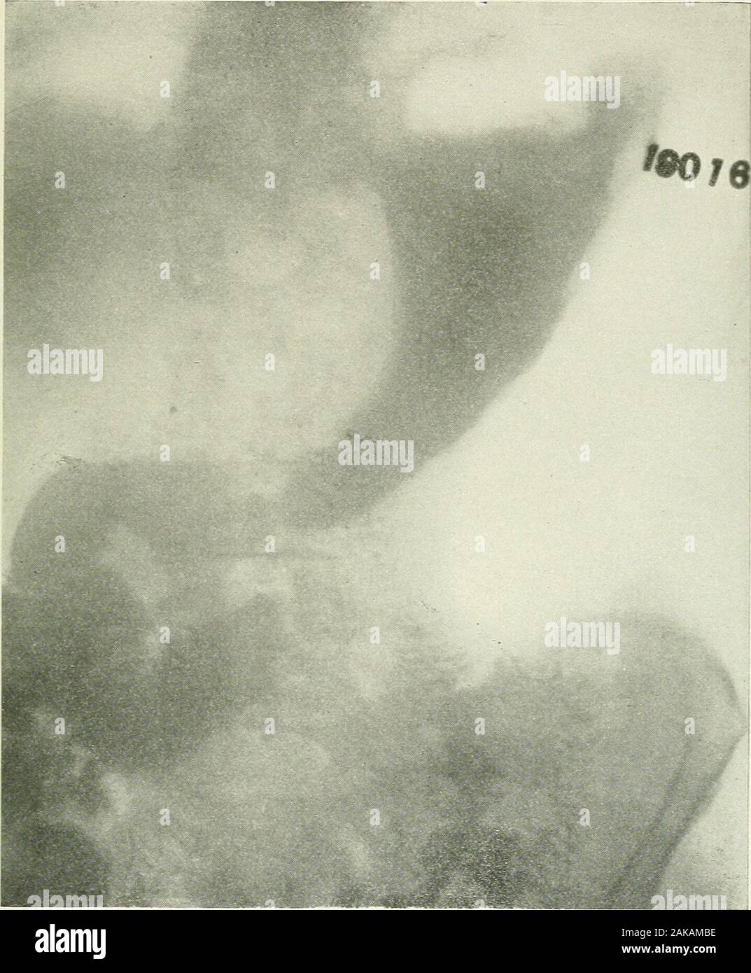Cancer of the stomach; a clinical study of 921 operatively and ...