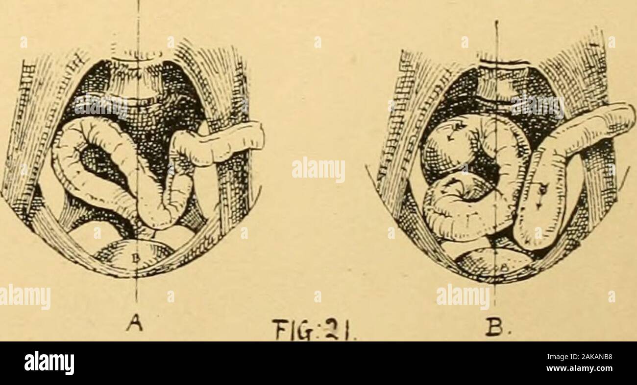 The anatomy of the intestinal canal and peritoneum in man . TlCr.20 ...