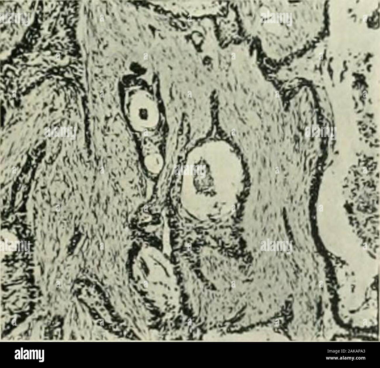 Gynecological diagnosis and pathology . Fig. 61.—Columnar Cell ...