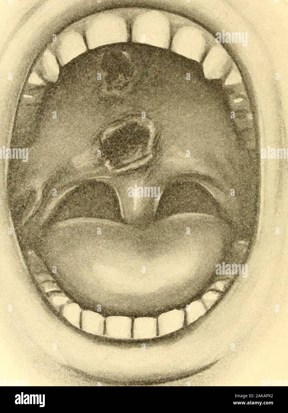 Syphilis chancre hi-res stock photography and images - Alamy