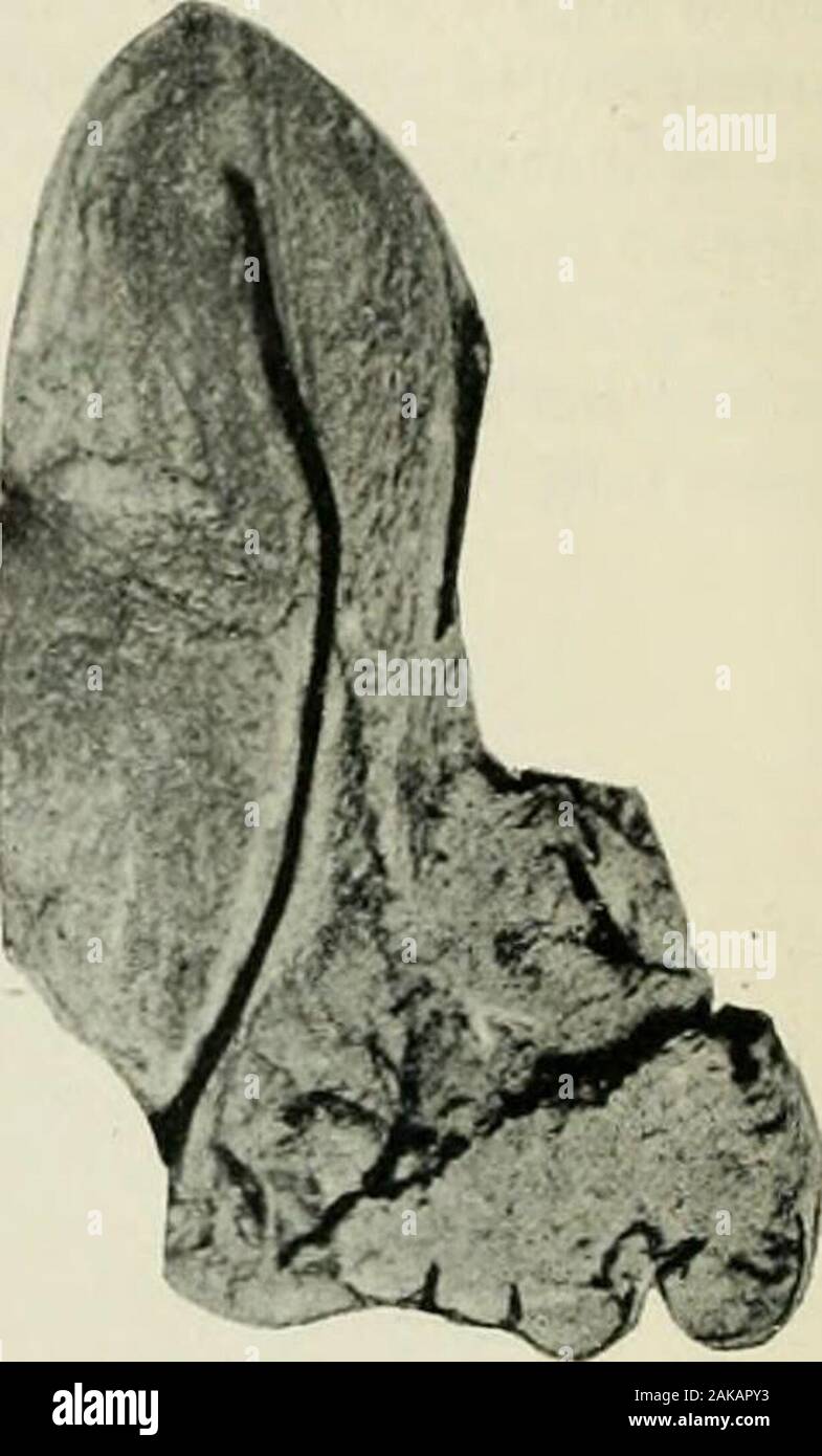 Gynecological diagnosis and pathology . Fig. 59.—Uterus Laid Open to ...
