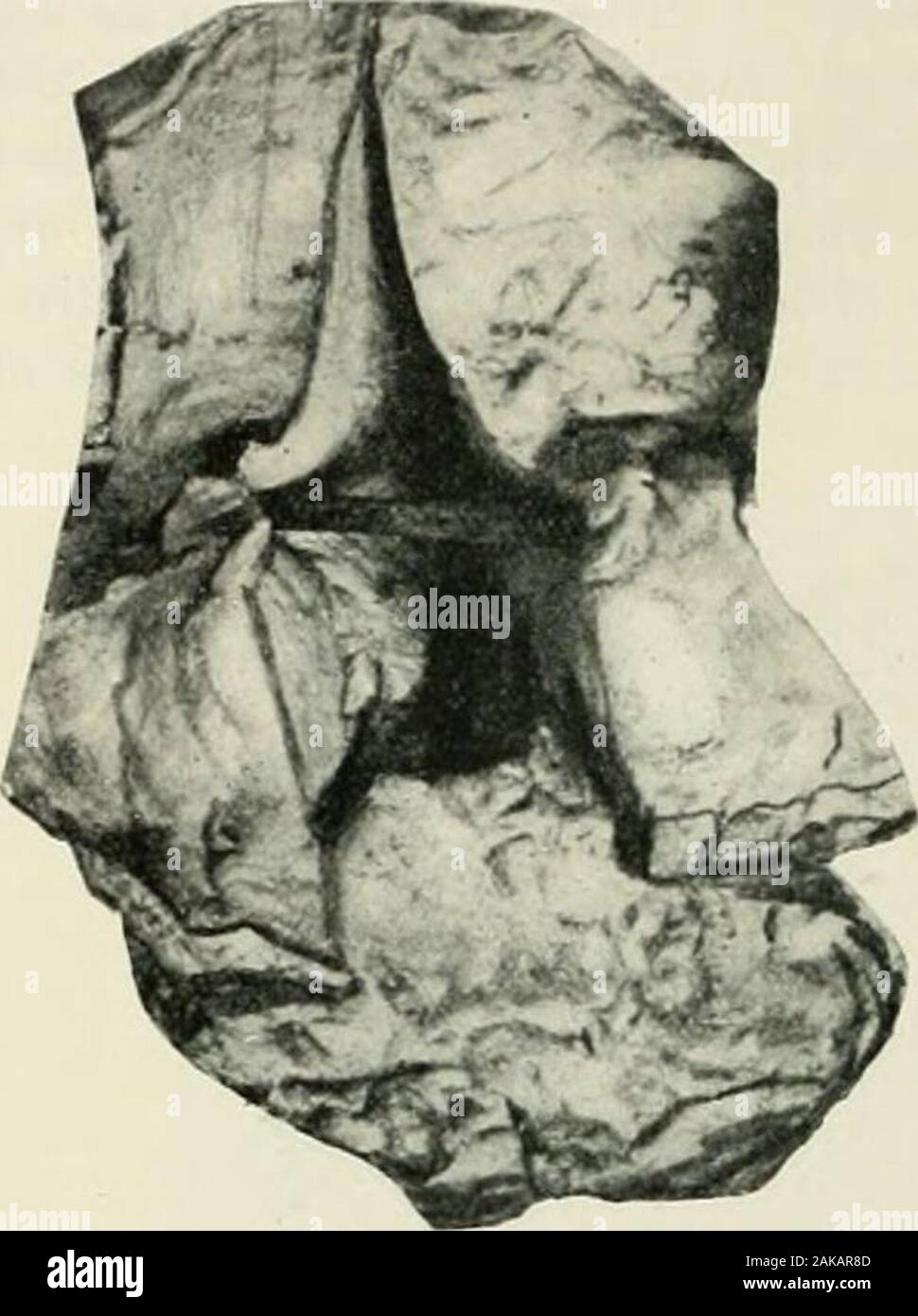 Gynecological diagnosis and pathology . Fig. 58.—Squamous Epithelioma ...