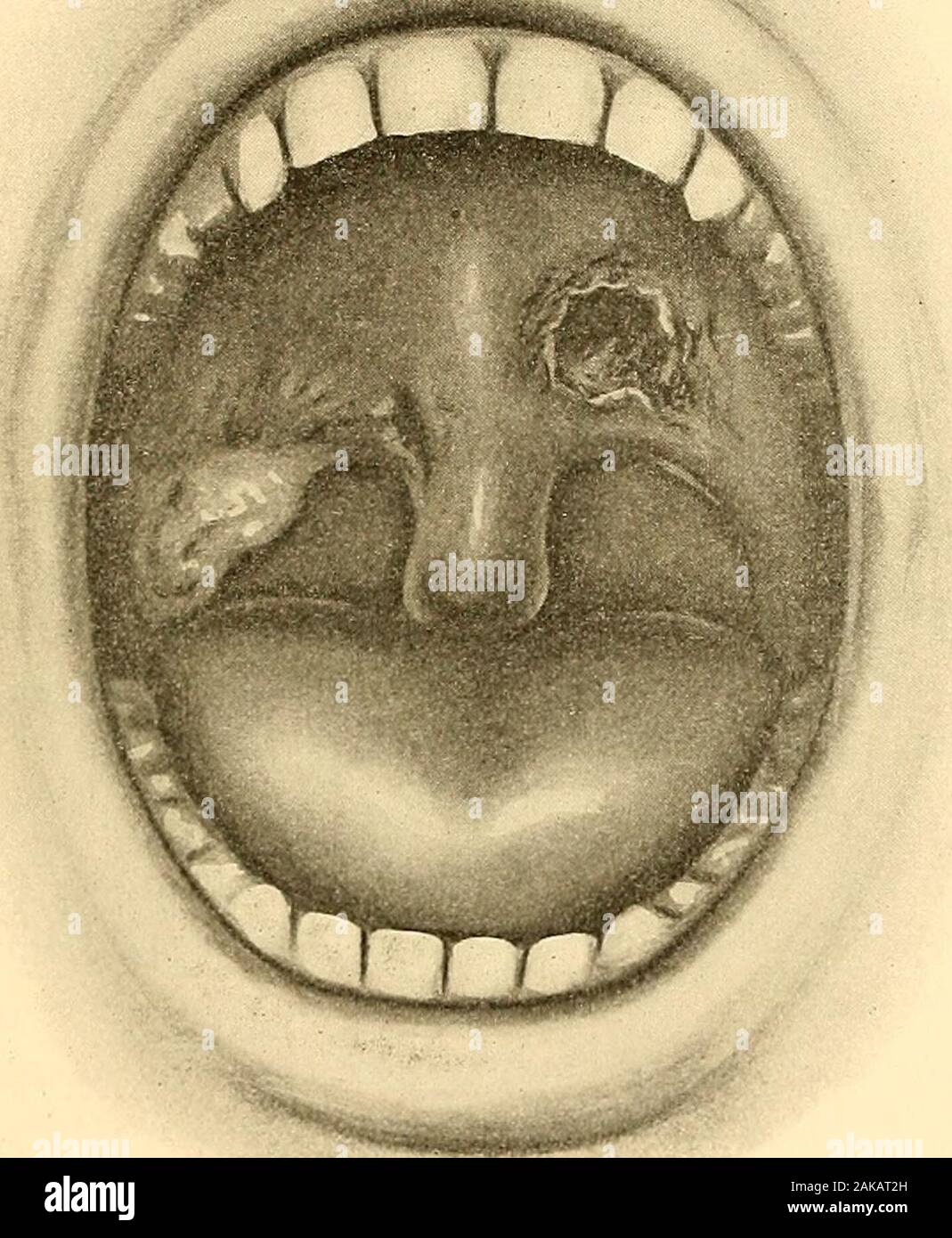 Secondary syphilis hi-res stock photography and images - Alamy