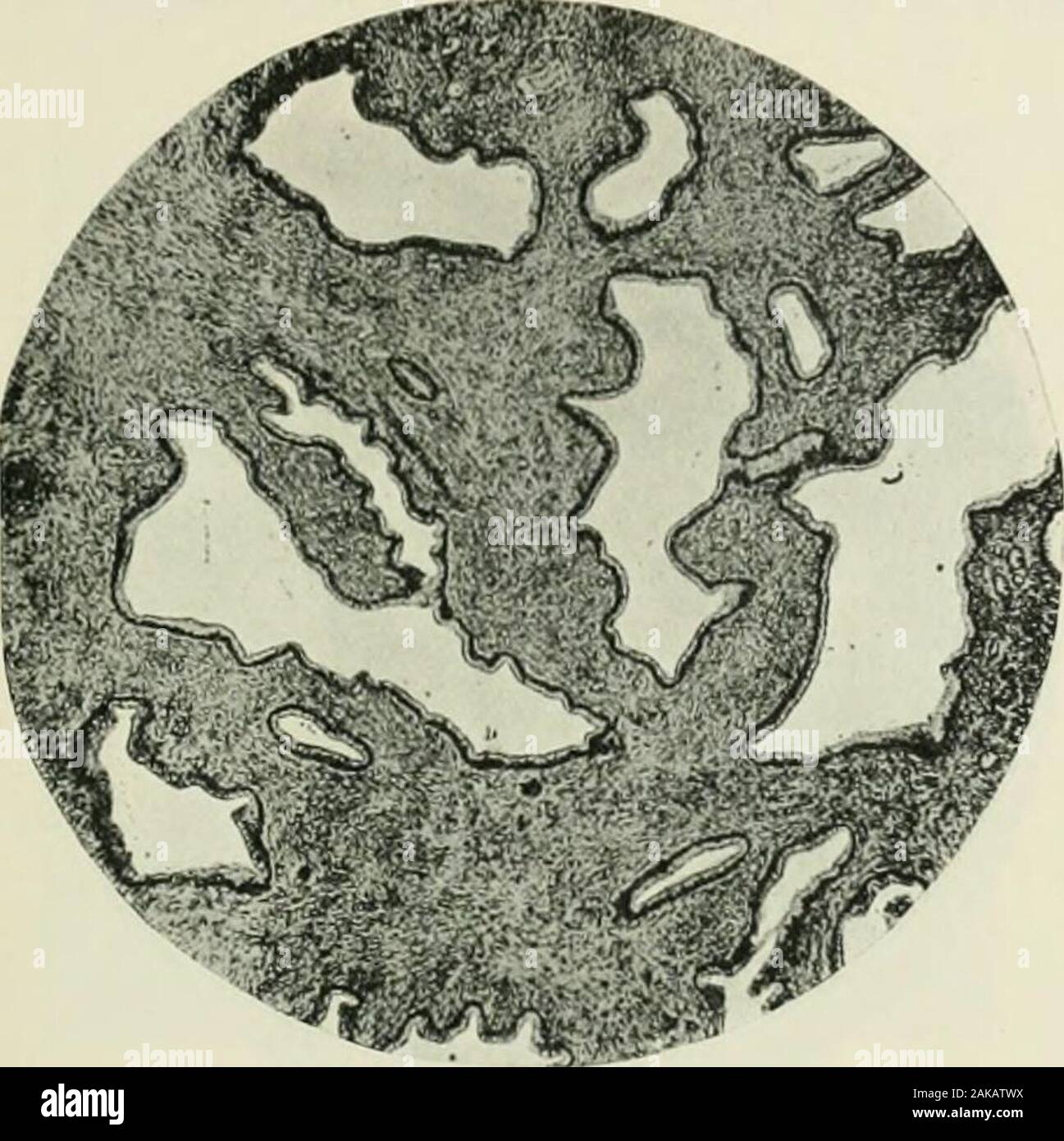 Gynecological diagnosis and pathology . Fig. 55.—Mucous Polyius of ...
